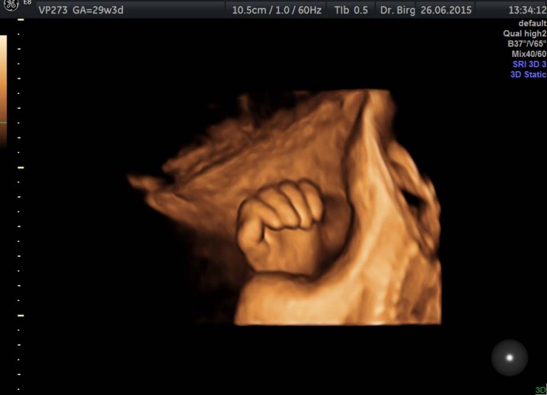3D / 4D Ultraschall – Pränataldiagnostik